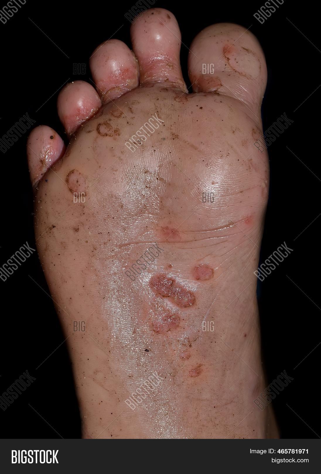 Scabies Infestation Image & Photo (Free Trial) | Bigstock