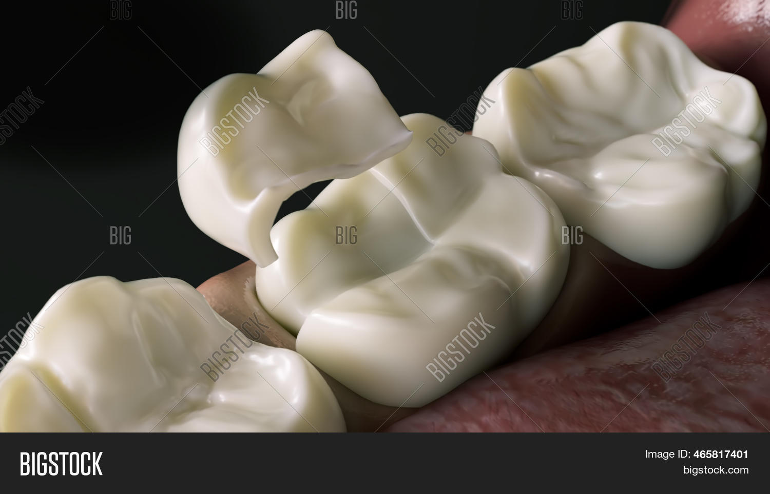 Ceramic Onlay Quarter Image & Photo (Free Trial) | Bigstock