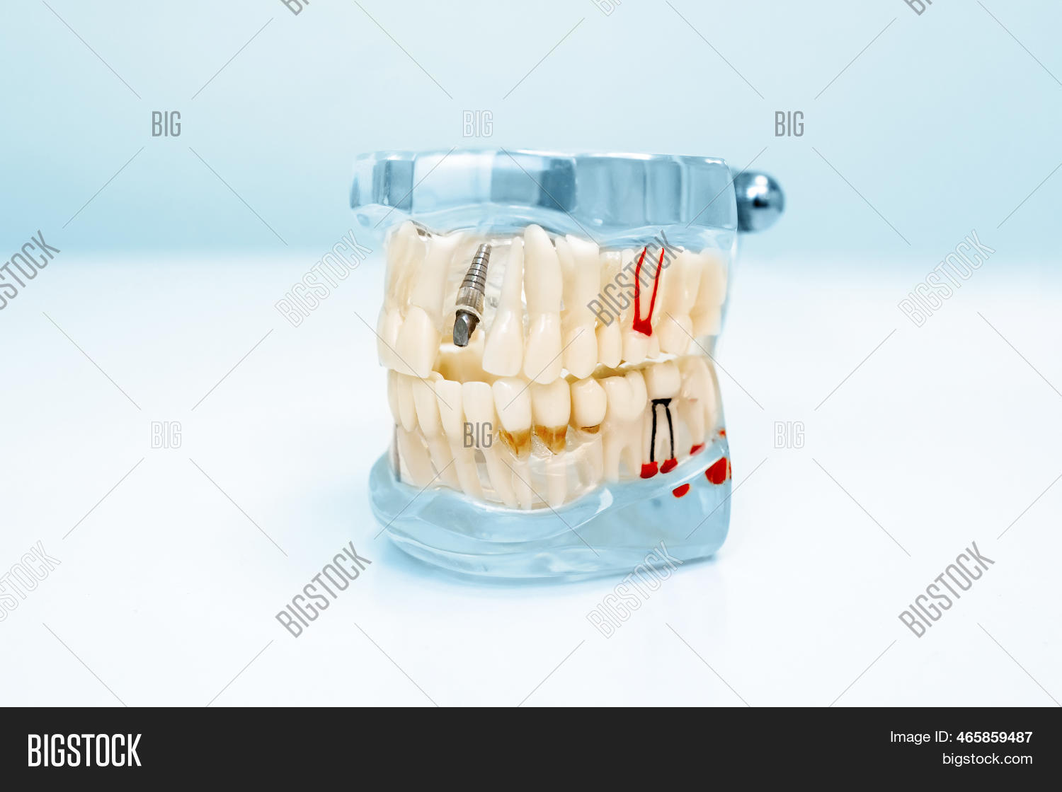 Dental Implant. Image & Photo (Free Trial) | Bigstock