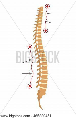 Spinal Deformity. Vector & Photo (Free Trial) | Bigstock