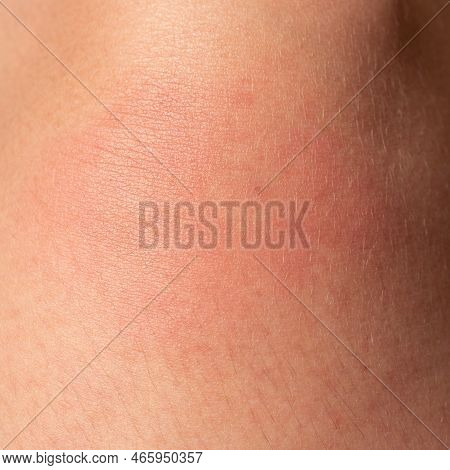 Allergy On Human Body Image & Photo (Free Trial) | Bigstock