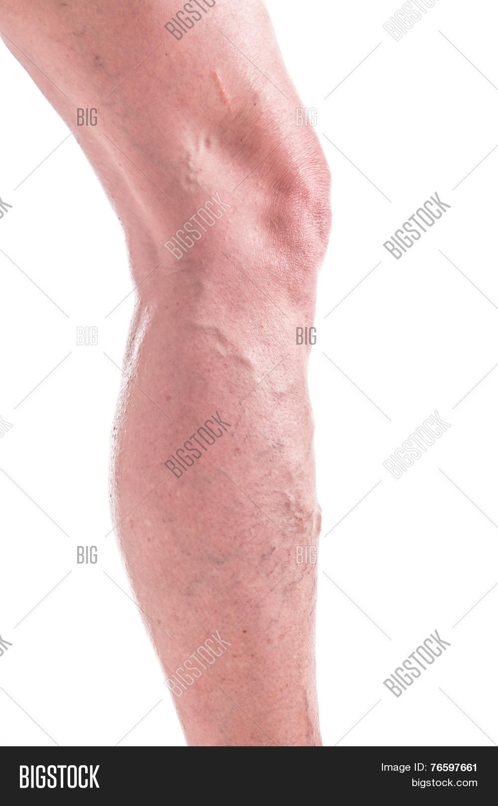 Varicose Veins On Legs Image & Photo (Free Trial) | Bigstock