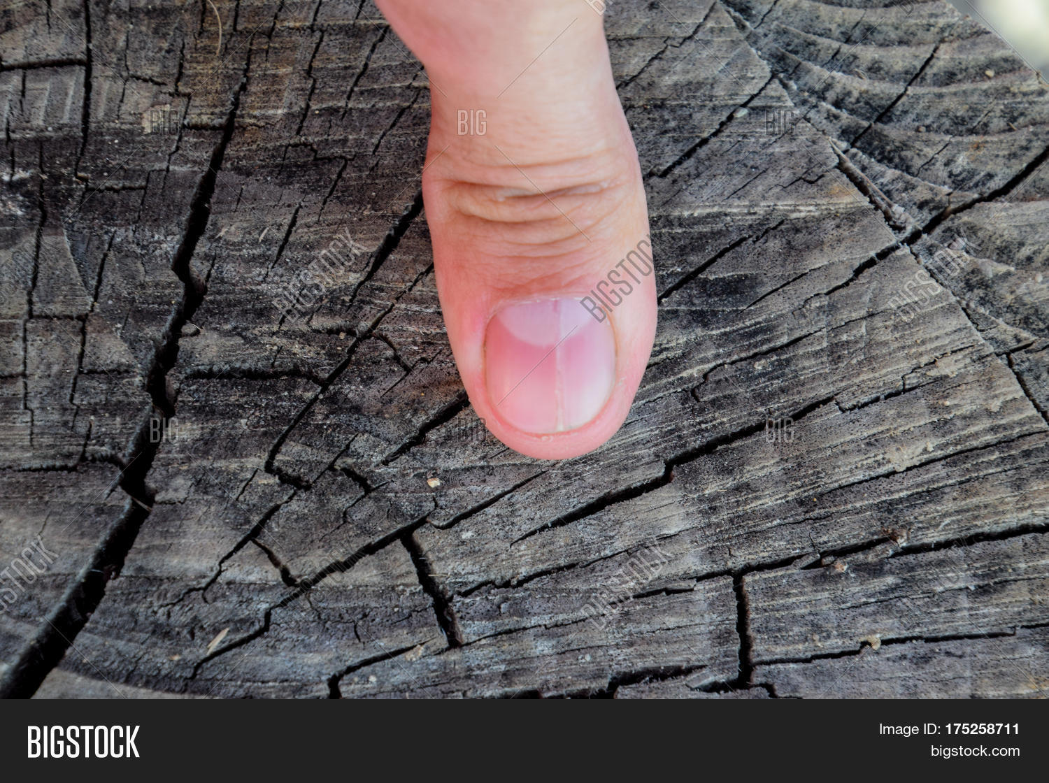 Forked Nail On Thumb. Image & Photo (Free Trial) | Bigstock