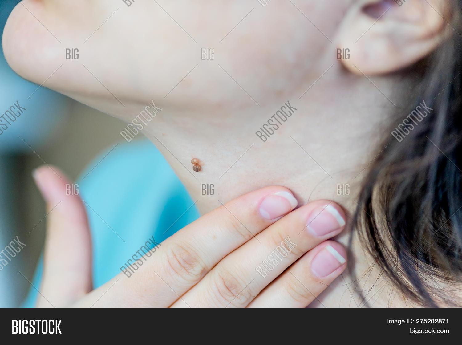 Birthmark Mole On Image & Photo (Free Trial) | Bigstock