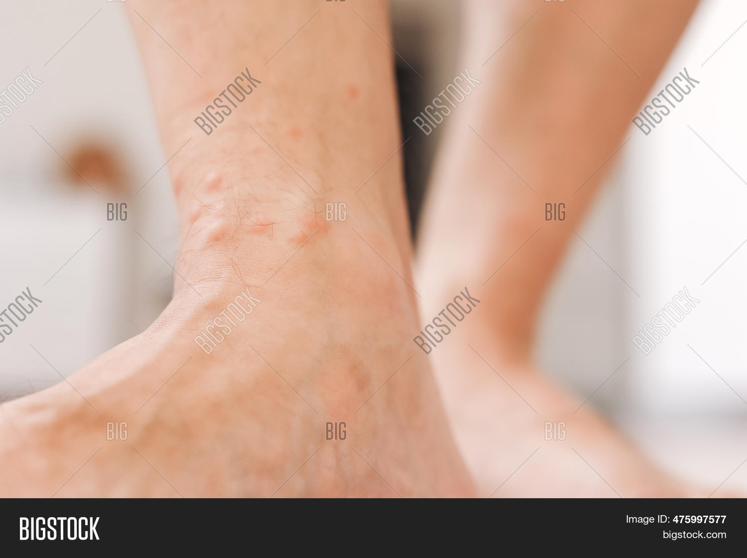 Close Allergic Rash Image & Photo (Free Trial) | Bigstock
