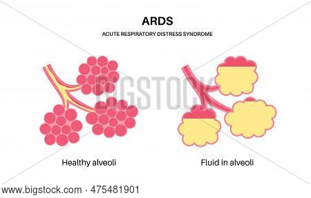 Acute Respiratory Vector & Photo (Free Trial) | Bigstock