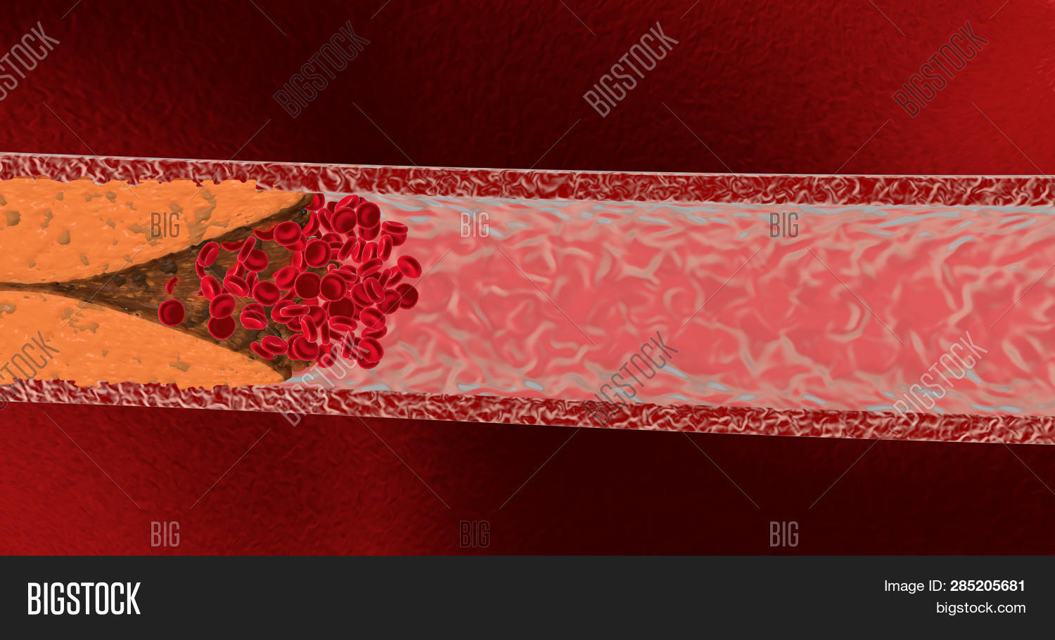 Blocked Blood Vessel. Image & Photo (Free Trial) | Bigstock