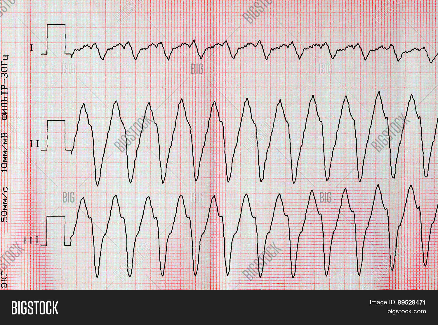 Tape Ecg Paroxysm Image & Photo (Free Trial) | Bigstock