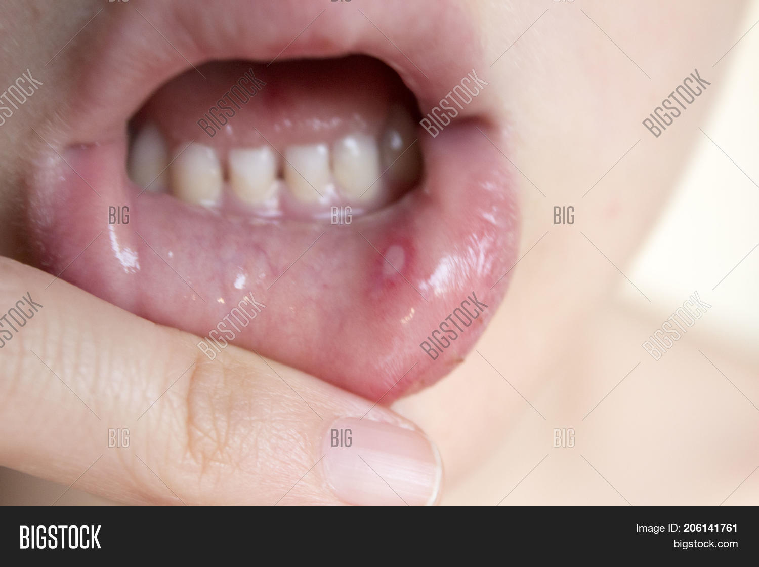 Children Aphtha On Lip Image & Photo (Free Trial) | Bigstock