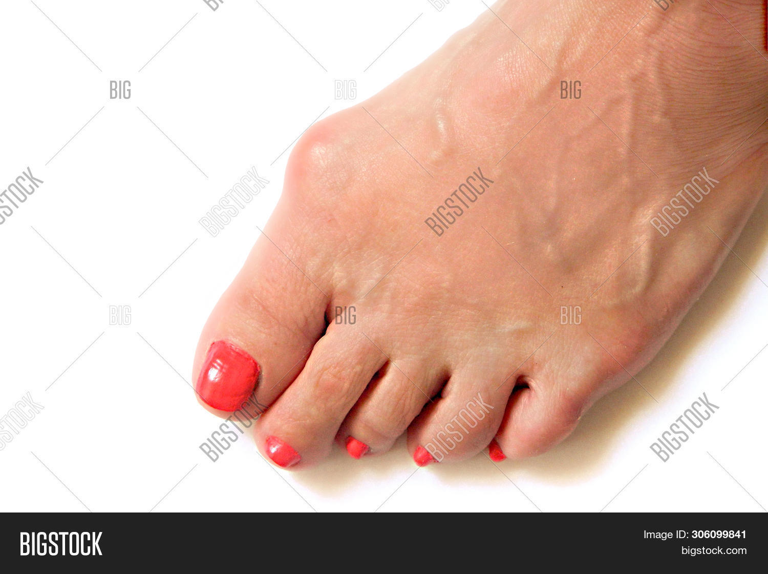 Varus Valgus Hallux Image & Photo (Free Trial) | Bigstock