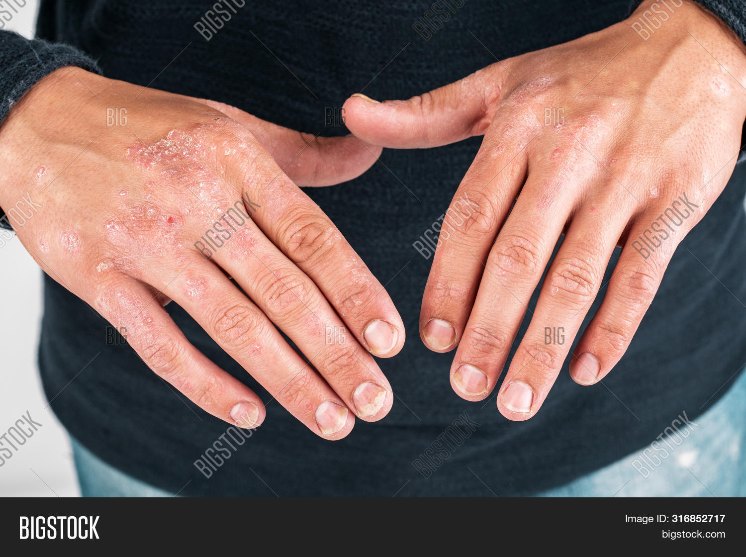 Man Sick Hands, Dry Image & Photo (Free Trial) | Bigstock
