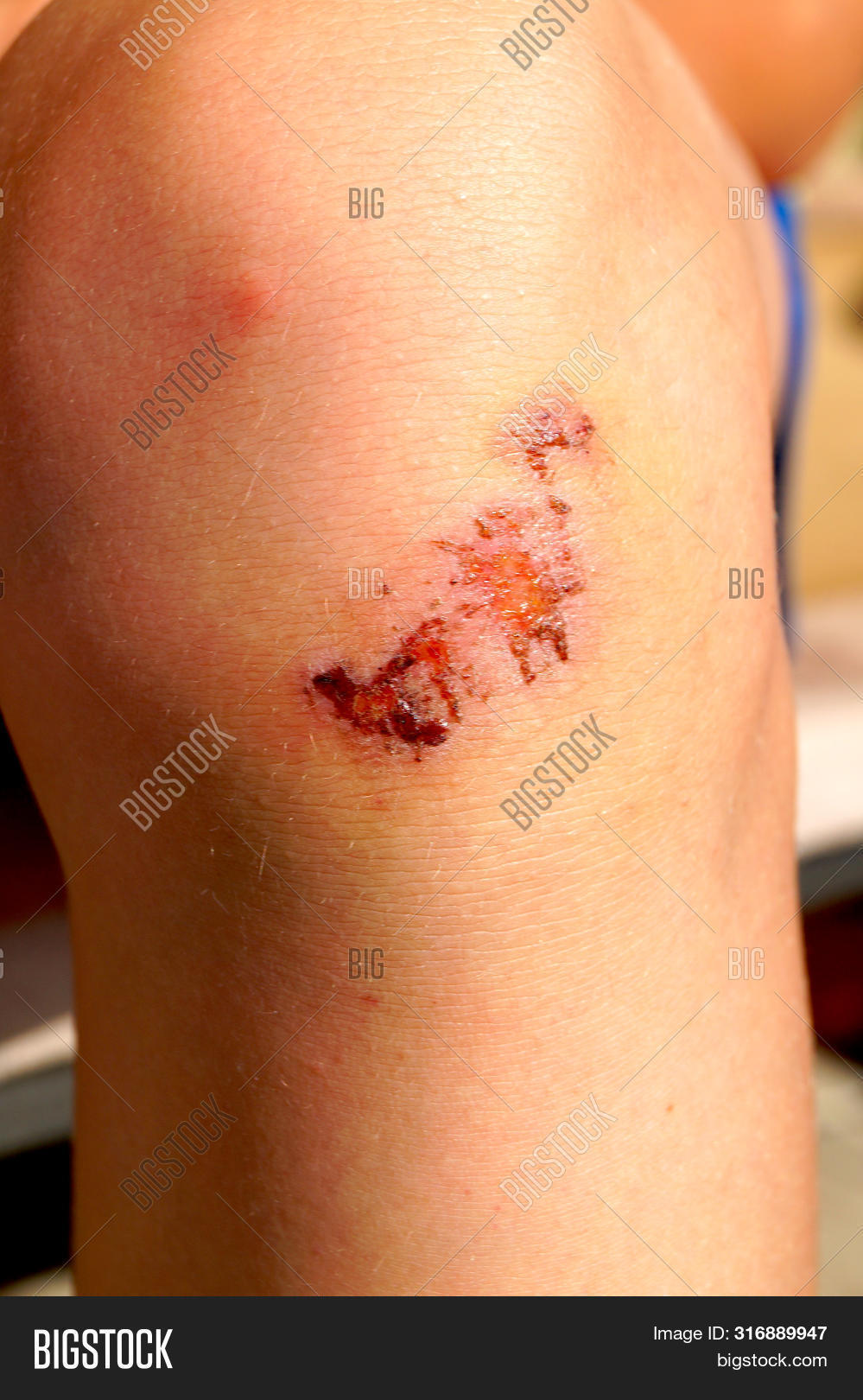 Dried Blood On Scratch Image & Photo (Free Trial) | Bigstock