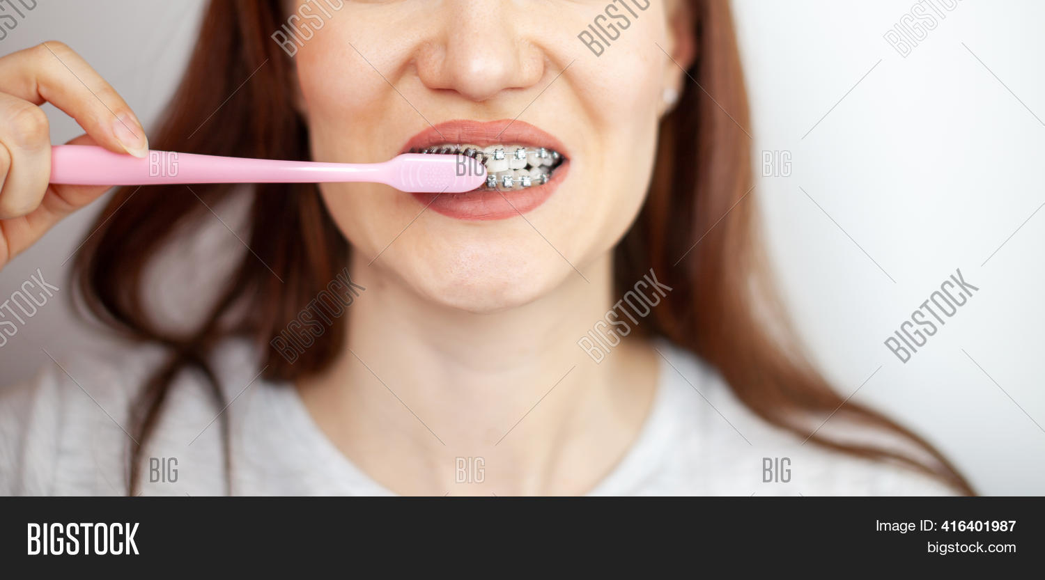 Girl Braces On Her Image And Photo Free Trial Bigstock