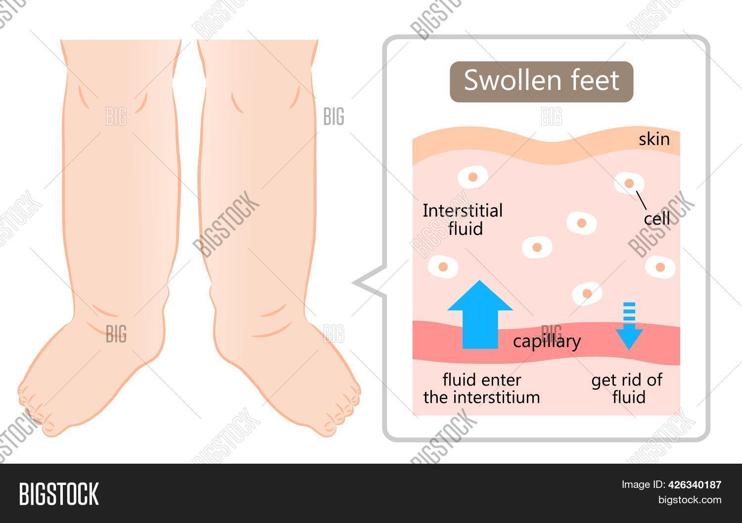 Diagram Swollen Feet Image & Photo (Free Trial) | Bigstock