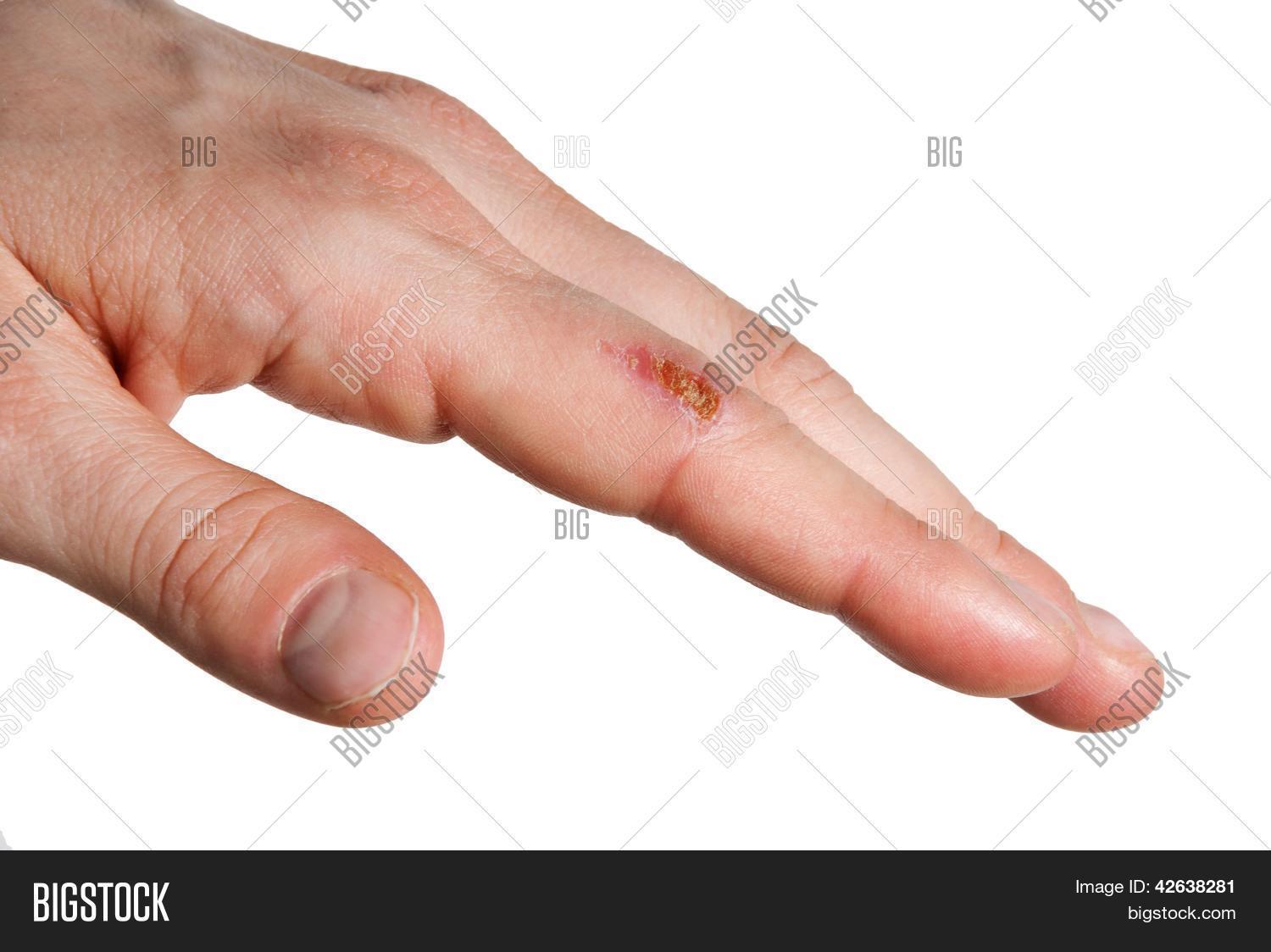 Wound Finger Image & Photo (Free Trial) | Bigstock