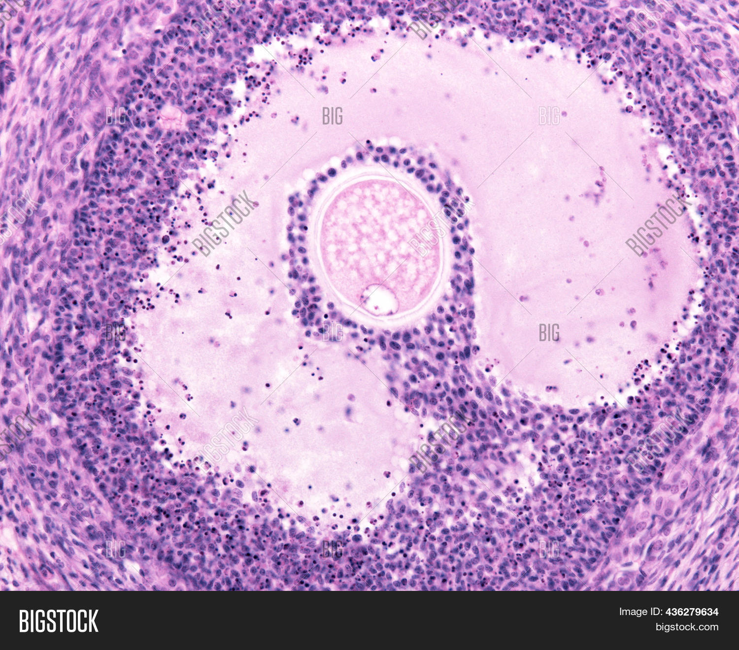 Atretic Tertiary Image & Photo (Free Trial) | Bigstock