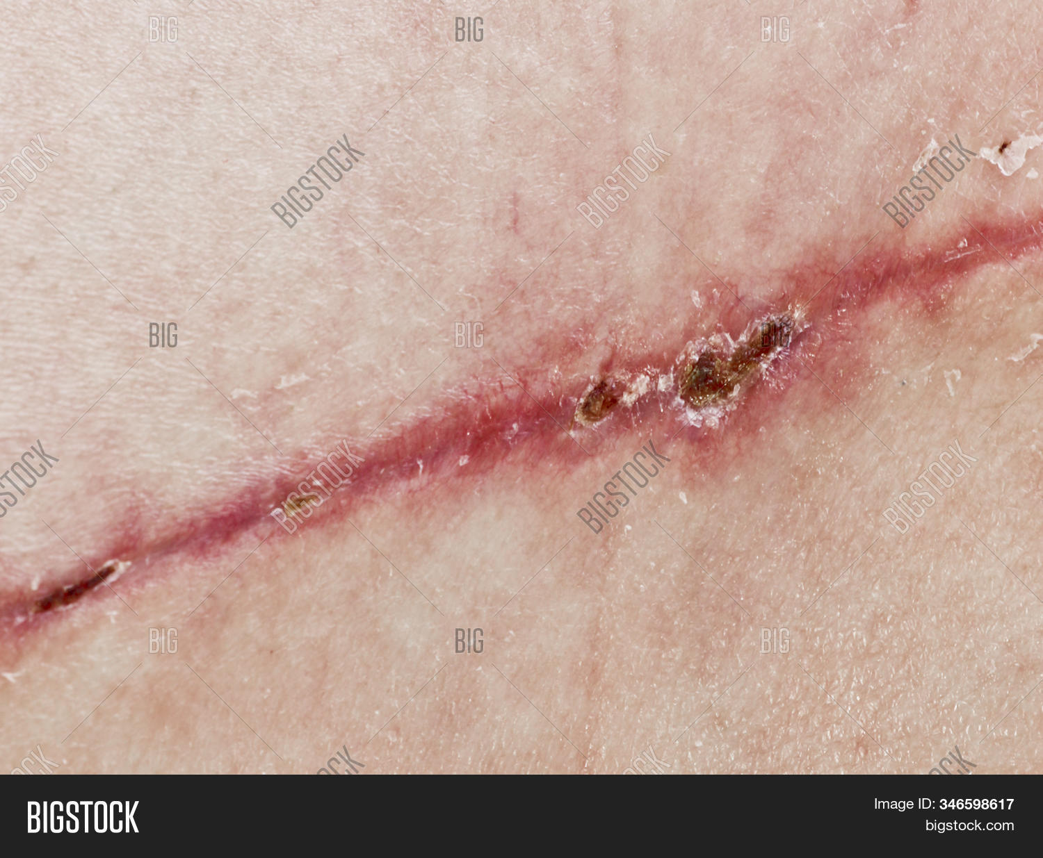 Seam After Surgery On Image & Photo (Free Trial) | Bigstock