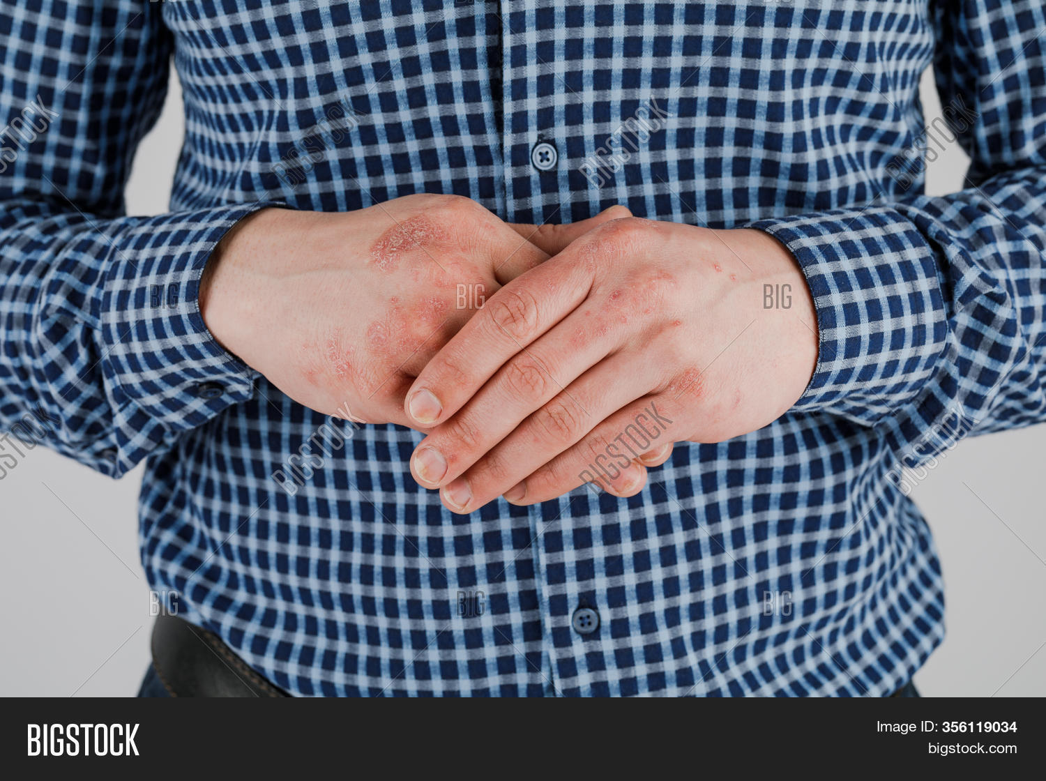 Man Sick Hands, Dry Image & Photo (Free Trial) | Bigstock