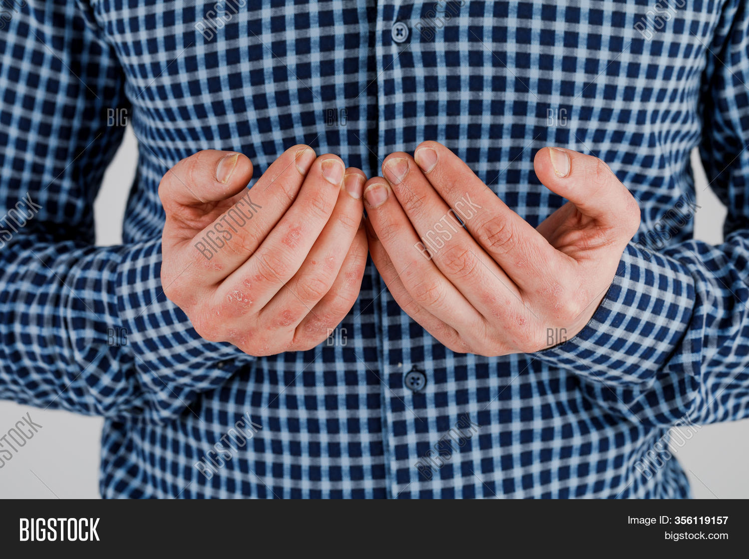 Man Sick Hands, Dry Image & Photo (Free Trial) | Bigstock