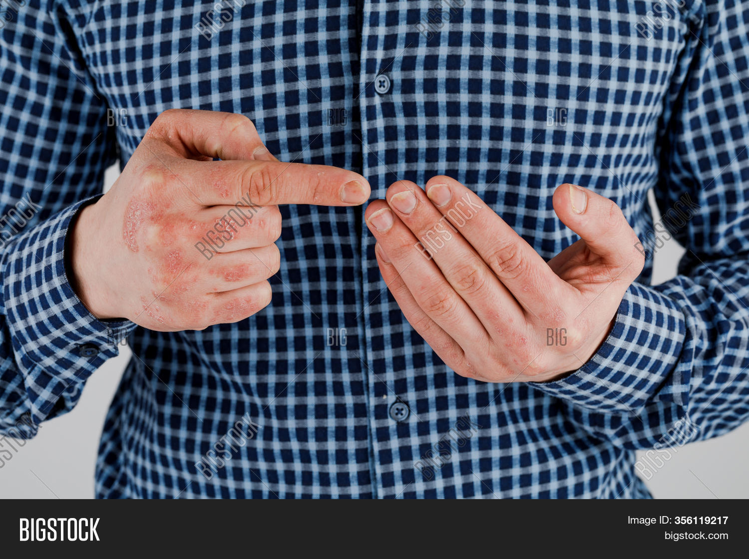 Man Sick Hands, Dry Image & Photo (Free Trial) | Bigstock