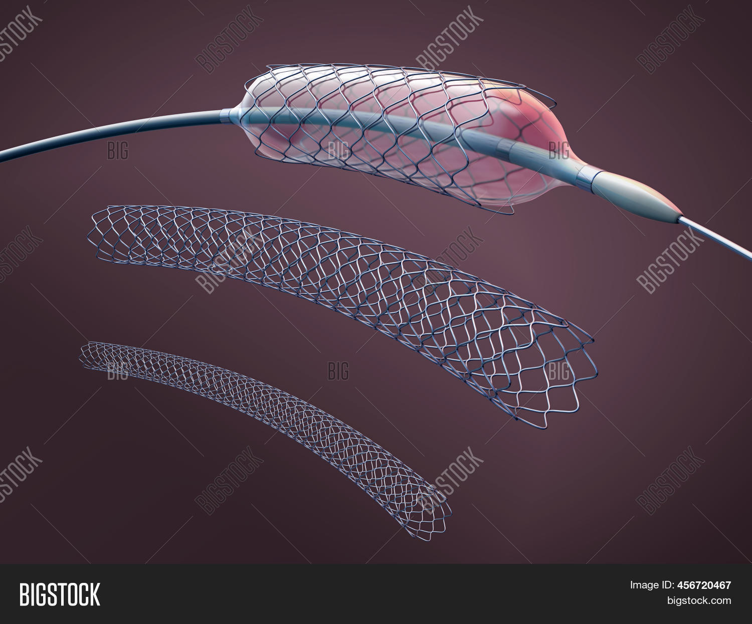 Three Metal Stents Image & Photo (Free Trial) | Bigstock