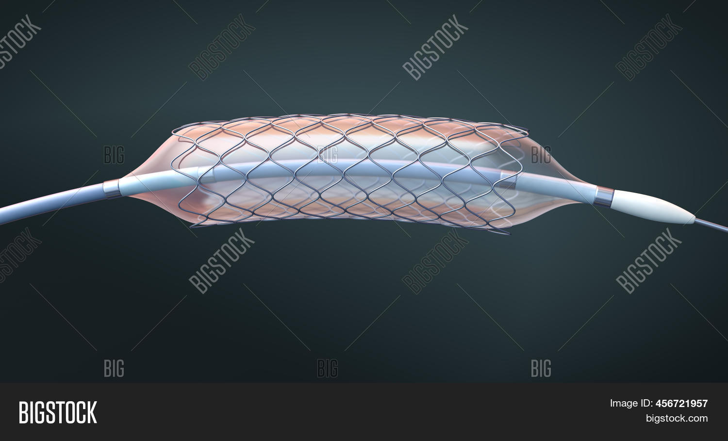 Stent Catheter Image & Photo (Free Trial) | Bigstock