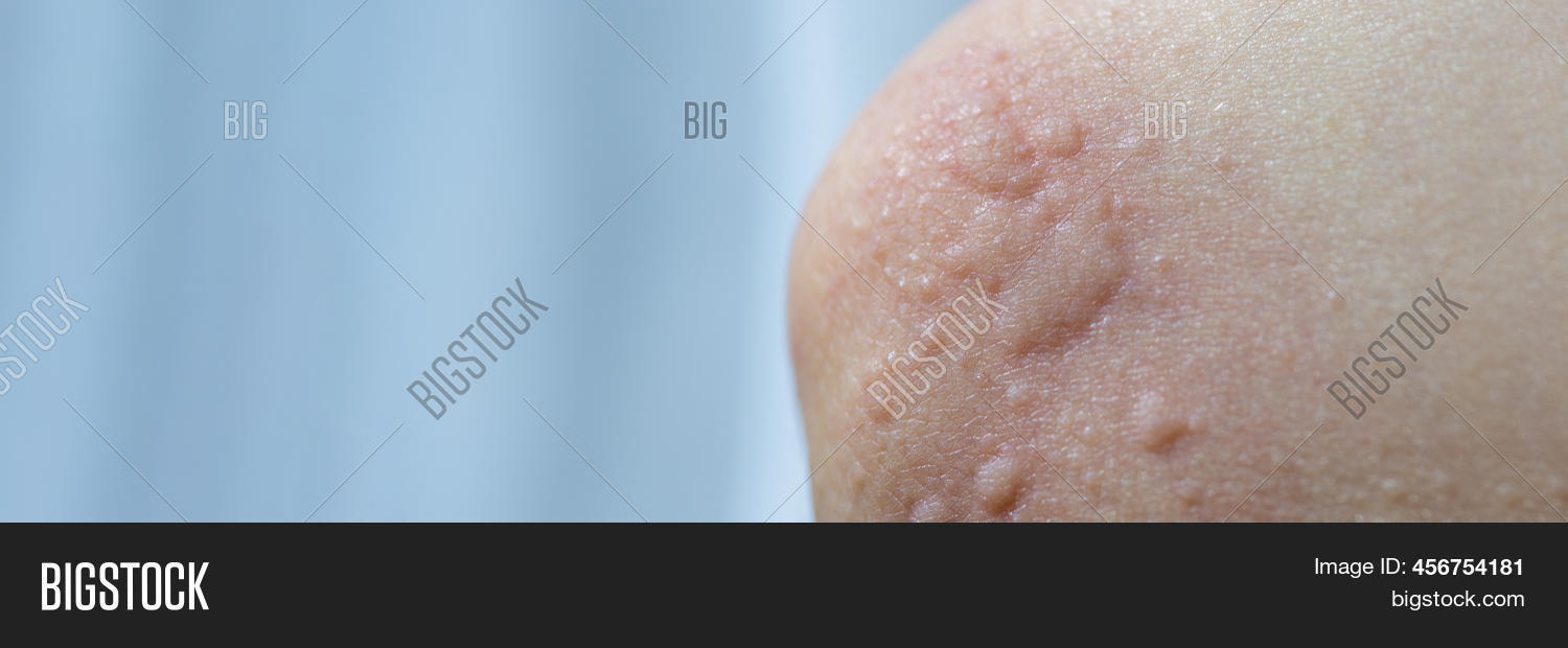 Urticaria On Skin. Red Image & Photo (Free Trial) | Bigstock