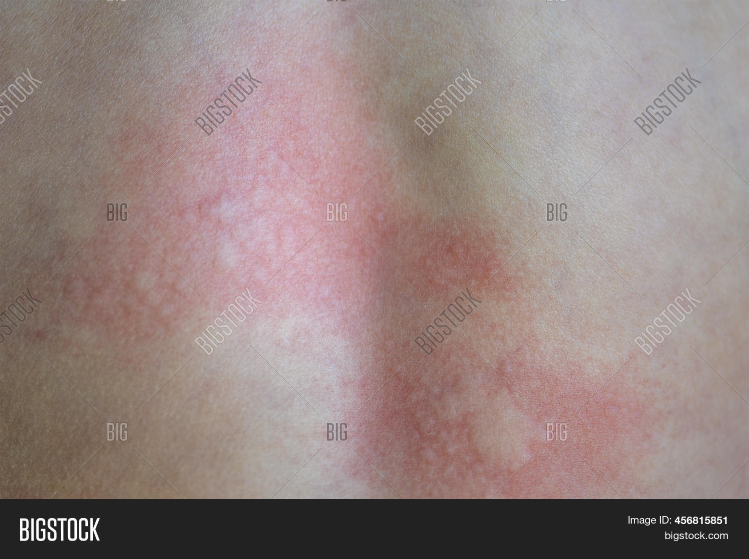 Urticaria On Skin. Red Image & Photo (Free Trial) | Bigstock