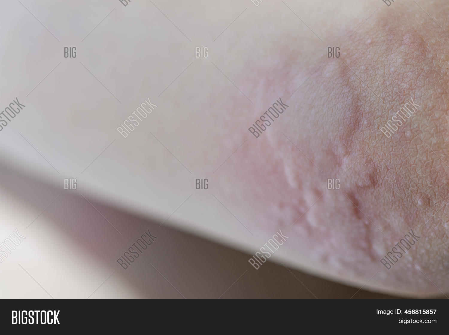 Urticaria On Skin. Red Image & Photo (Free Trial) | Bigstock