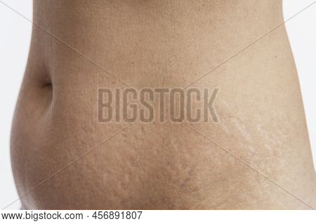 Stretch Marks On Woman Image & Photo (Free Trial) | Bigstock