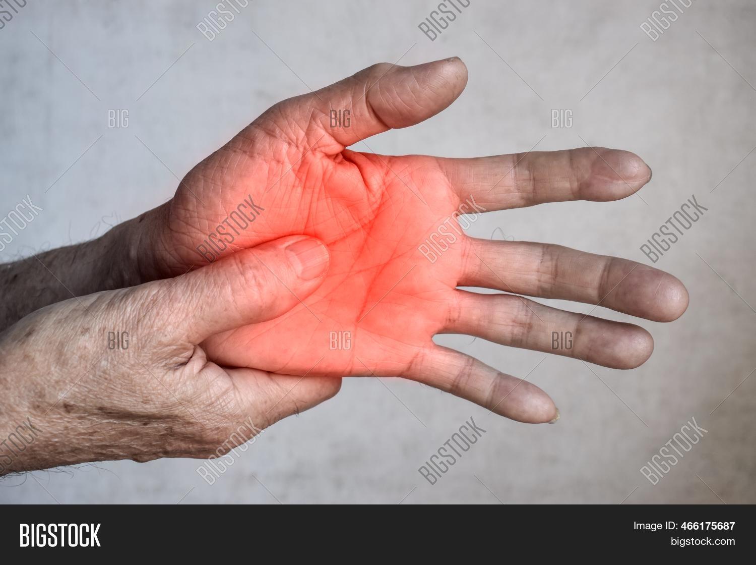 Painful Palmar Aspect Image & Photo (Free Trial) | Bigstock