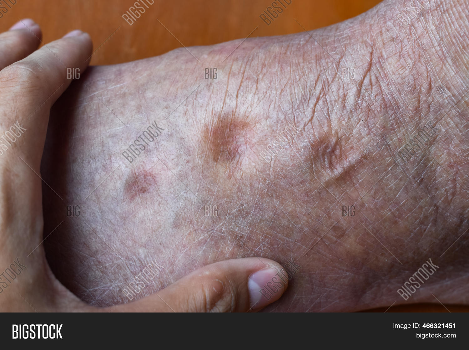 Pitting Edema Lower Image & Photo (Free Trial) | Bigstock