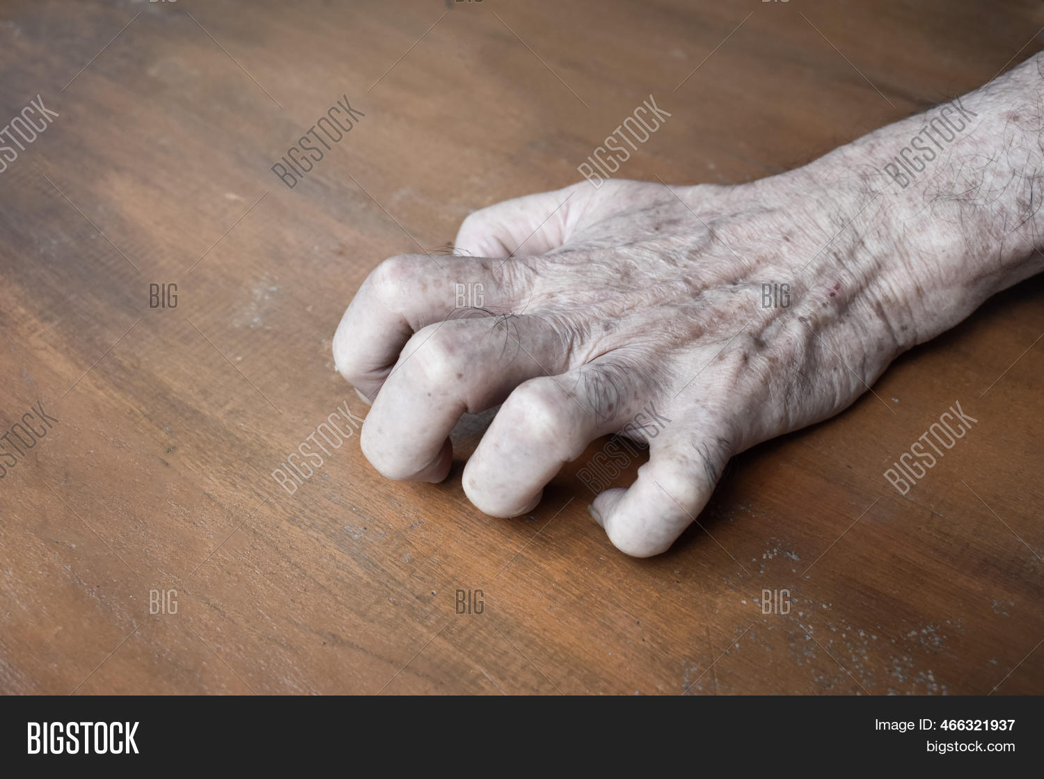 Volkmann Contracture Image & Photo (Free Trial) | Bigstock