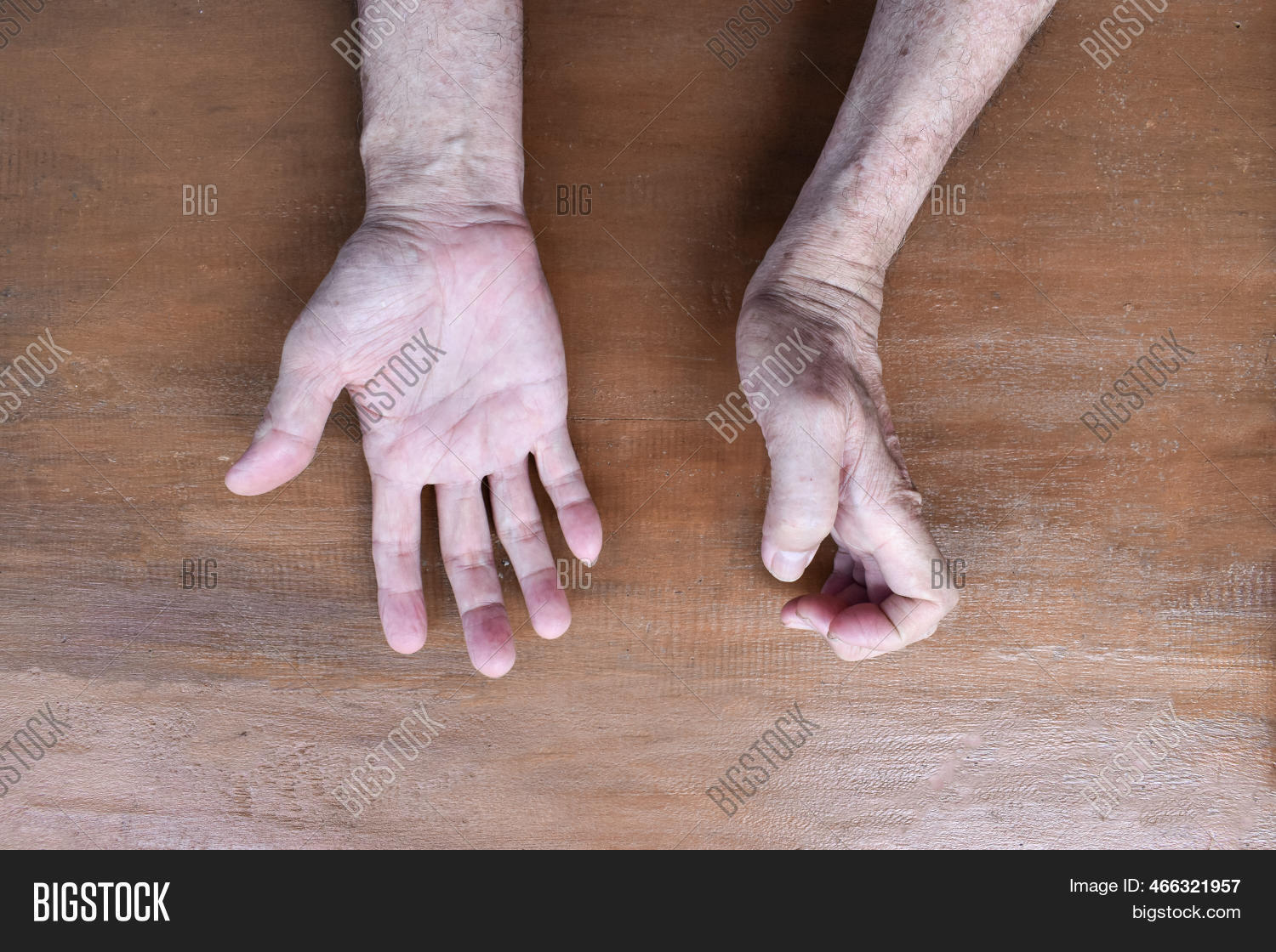 Volkmann Contracture Image & Photo (Free Trial) | Bigstock