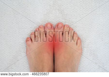 Feet Disease Image & Photo (Free Trial) | Bigstock