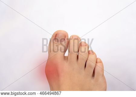 Foot Disease Image & Photo (Free Trial) | Bigstock