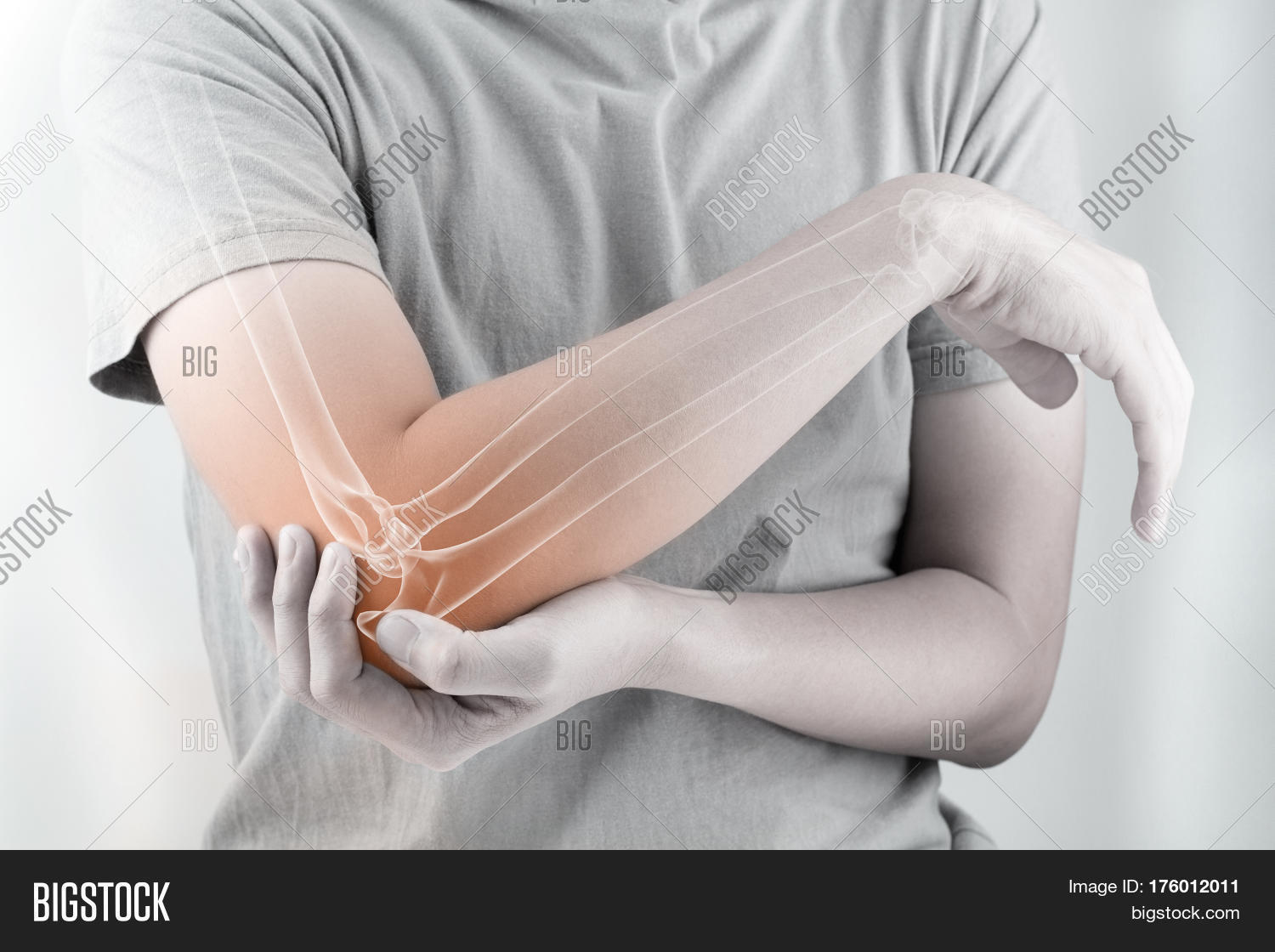 Elbow Bones Injury Image & Photo (Free Trial) | Bigstock
