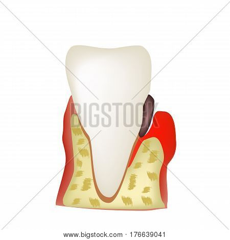 Periodontitis. Dental Vector & Photo (Free Trial) | Bigstock