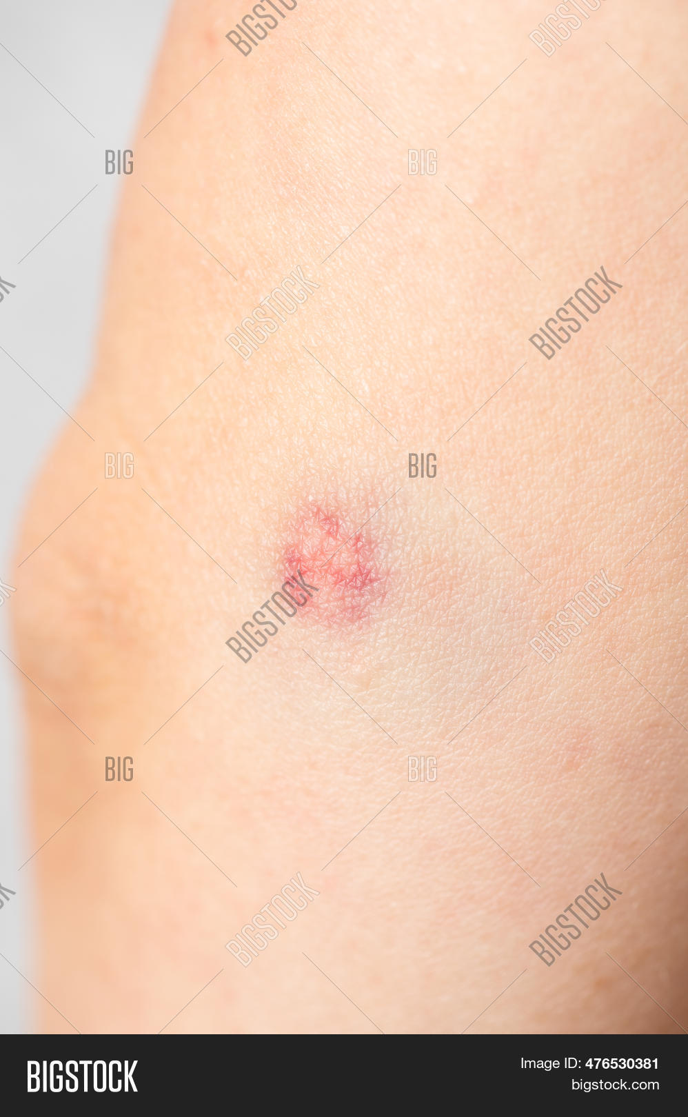 Big Bruise On Girls Image & Photo (Free Trial) | Bigstock