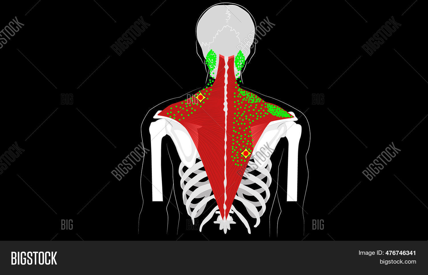 Trigger Points Image & Photo (Free Trial) | Bigstock