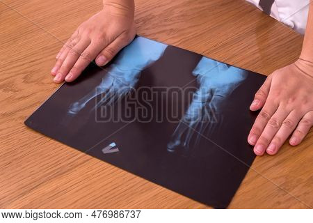 X-ray Patient's Foot Image & Photo (Free Trial) | Bigstock