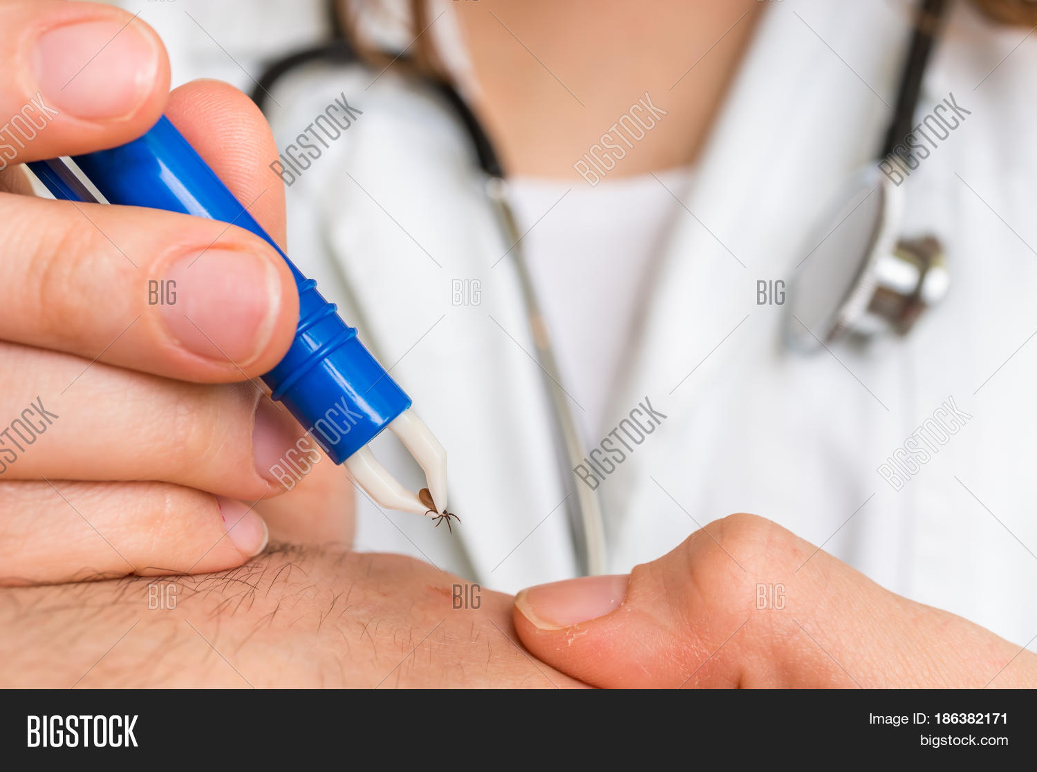 Doctor Removing Tick Image & Photo (Free Trial) | Bigstock