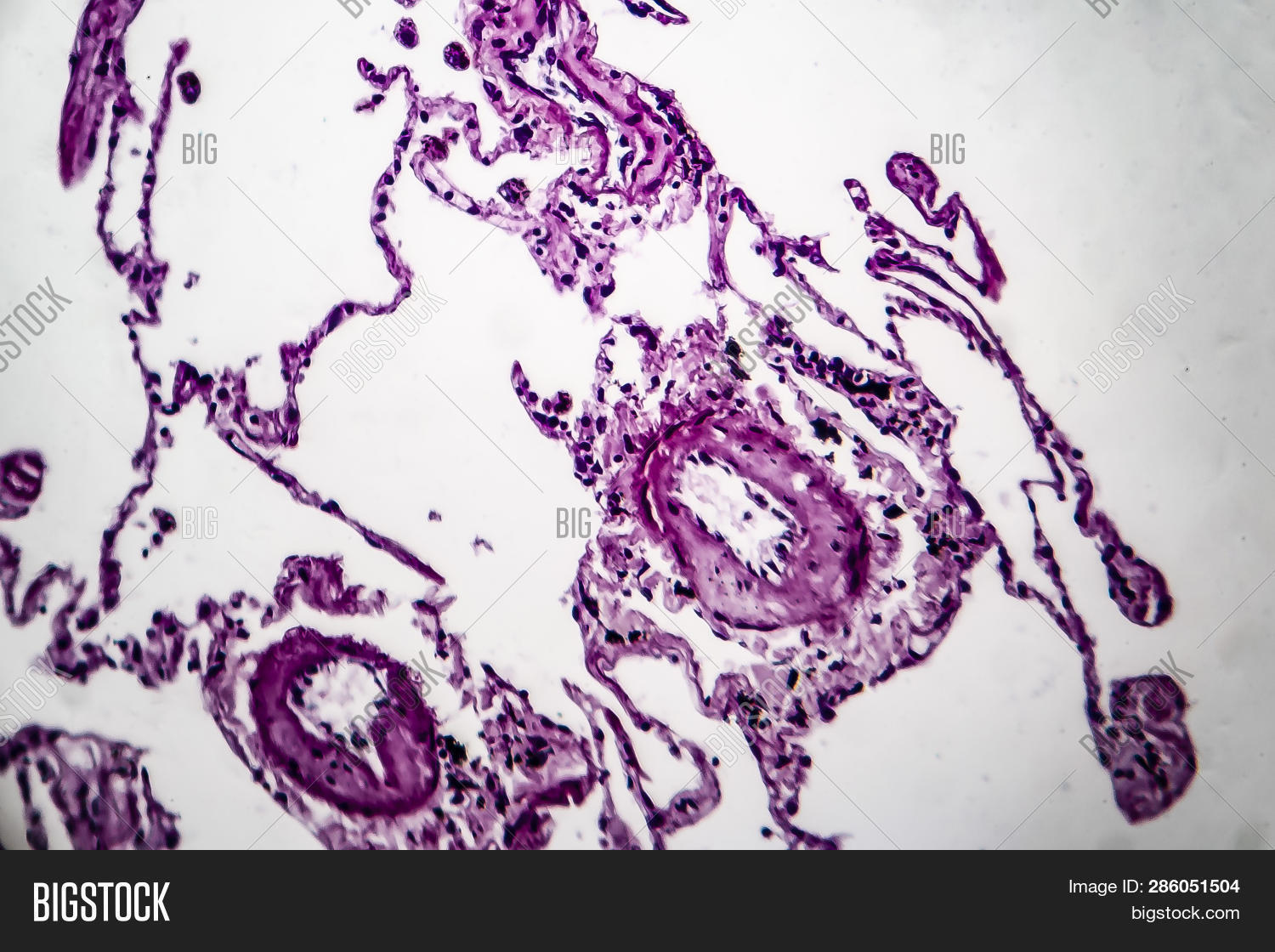 Histopathology Lung Image & Photo (Free Trial) | Bigstock