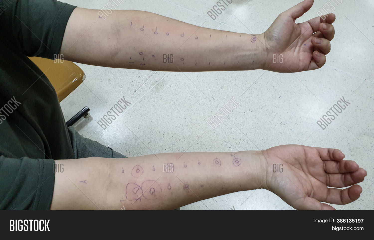 Arm Test Allergy Image & Photo (Free Trial) | Bigstock