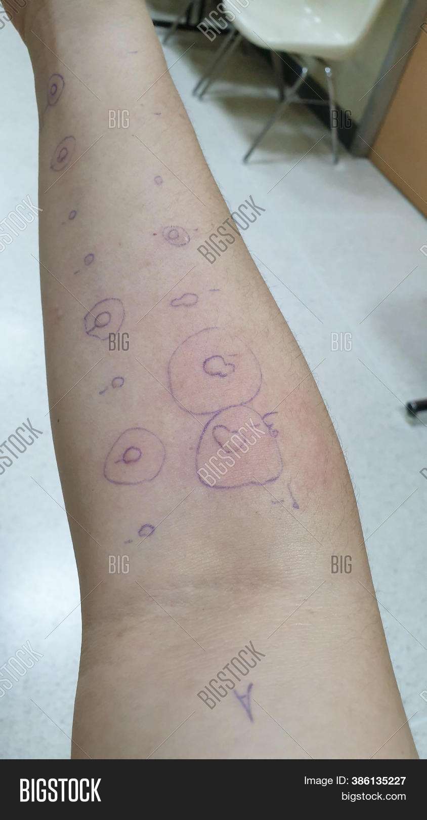 Arm Test Allergy Image & Photo (Free Trial) | Bigstock