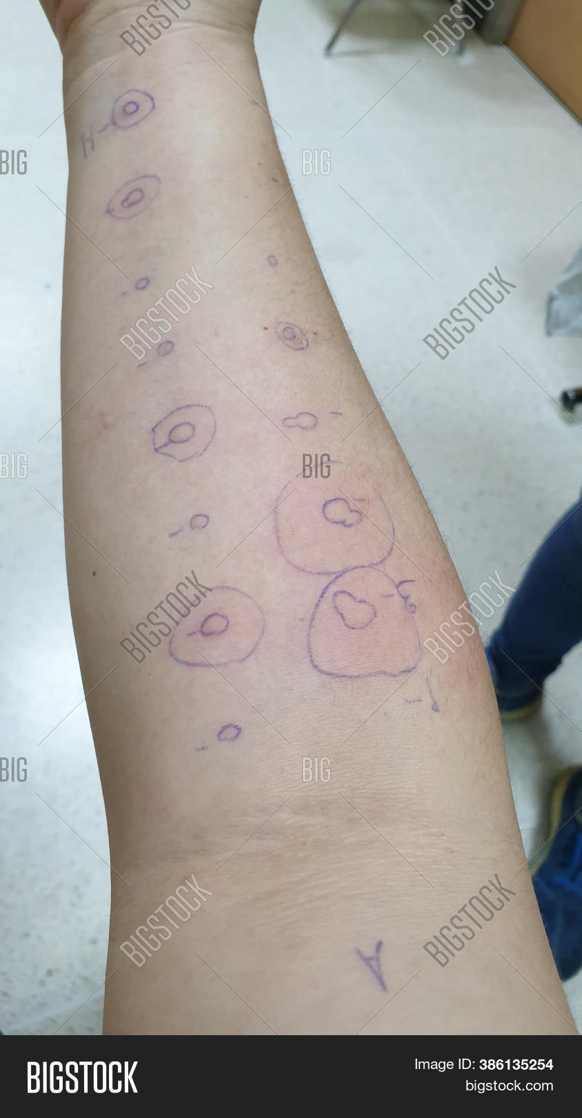 Arm Test Allergy Image & Photo (Free Trial) | Bigstock