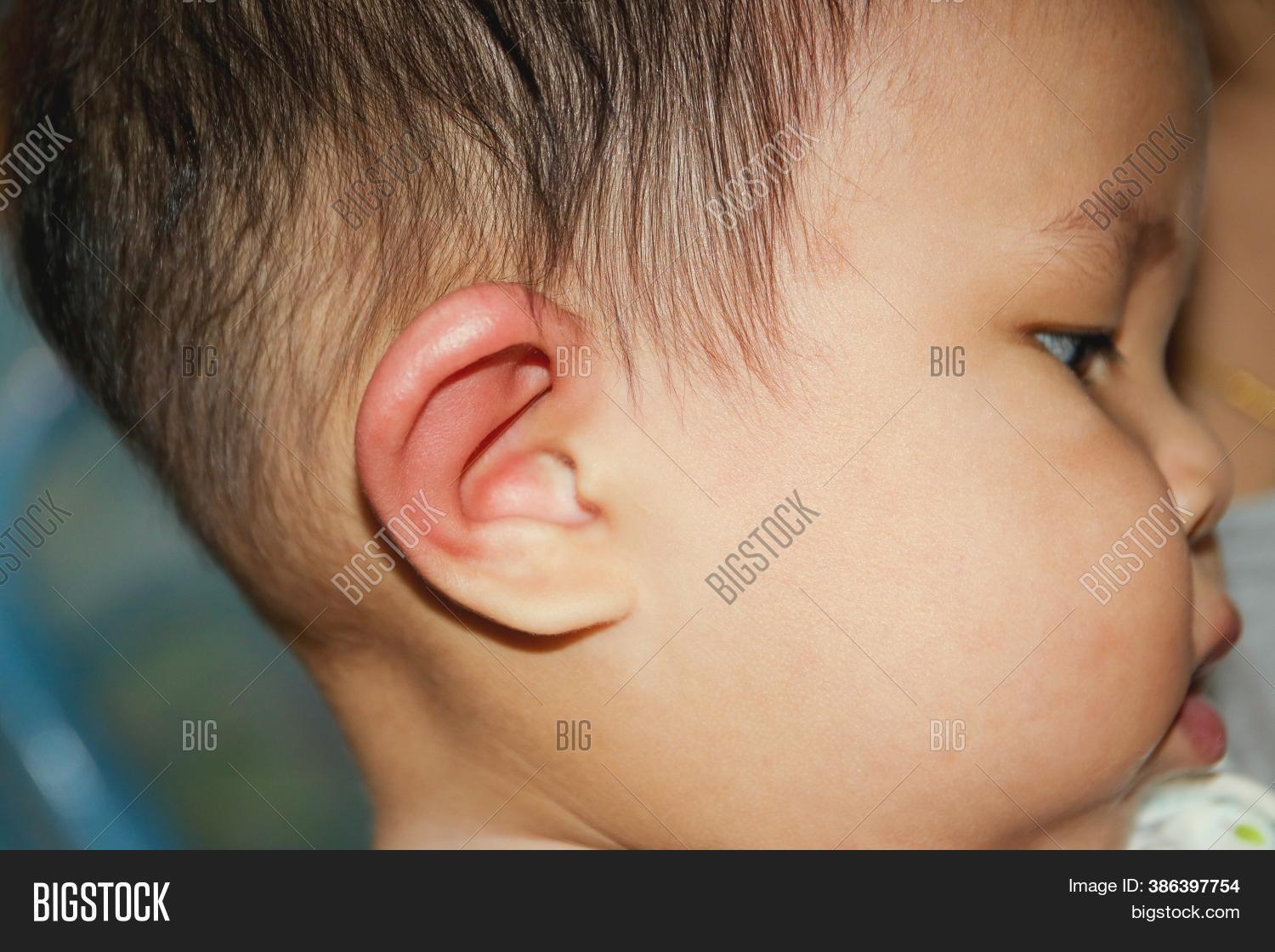 Mosquito Bites On Babies Swelling