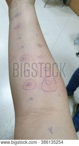 Arm Test Allergy Image & Photo (Free Trial) | Bigstock