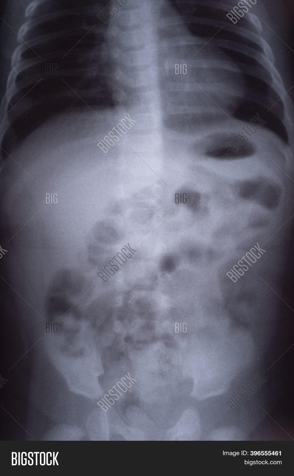 Intestinal Obstruction Image & Photo (Free Trial) | Bigstock