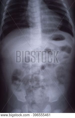 Intestinal Obstruction Image & Photo (Free Trial) | Bigstock